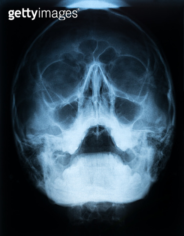 Xray film of a skull of a patient with paranasal sinus with acute right ...