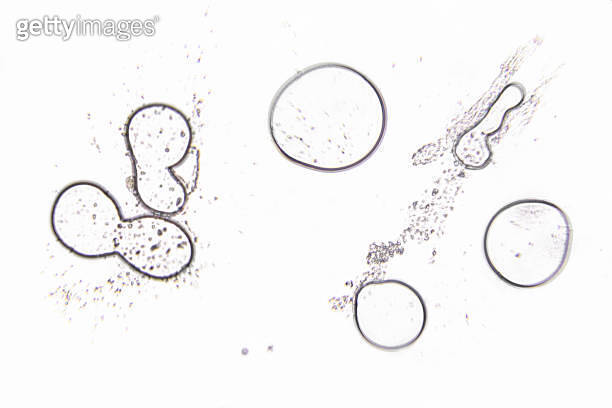 Urinary tract infection under the microscope 이미지 (1018424276) - 게티이미지뱅크