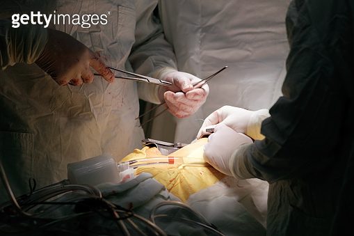 surgeons operating during cardiac operation of CABG 이미지 (980288314 ...
