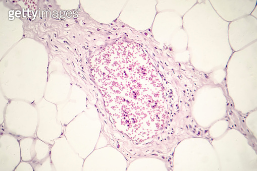 Lipoma, benign growth of fatty tissue 이미지 (1018969180) - 게티이미지뱅크