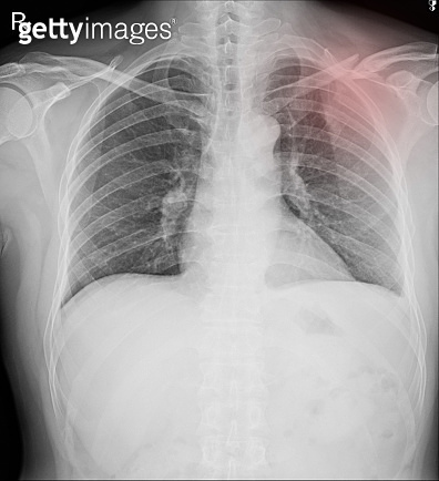 Chest x-ray Fractures left clavicle, anterior 2nd rib, posterior rib 4 ...