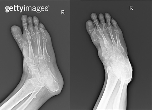 X-ray foot AP,LATERAL a Woman 68 year old.Showing Soft tissue swelling ...