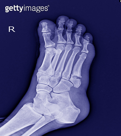X-ray foot : 5th Metatarsal Base Fracture small bone.Fracture foot. 이미지 ...