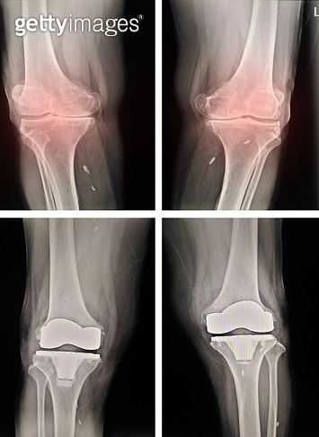 X-ray Osteoarthritis of knee OA and post operation Total Knee ...