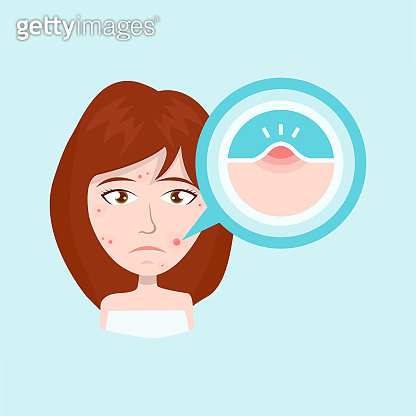 Acne infographic. Vector modern flat style cartoon character ...