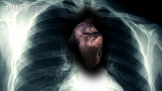 Sick Human Heart Inside Of X-Ray 이미지 (957745160) - 게티이미지뱅크