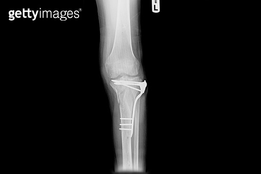 internal of left leg fixed with plate and screws. (1085913930) - 게티이미지뱅크