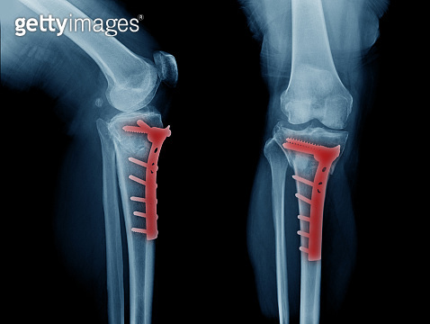 fracture proximal tibia with internal fixation AP and lateral view ...