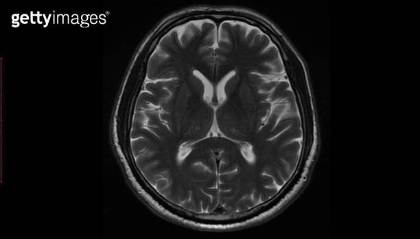 Brain MRI Scan of Healthy Male ( Magnetic Resonance Imaging) High ...