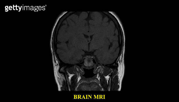 Brain MRI Scan of Healthy Male ( Magnetic Resonance Imaging) High ...