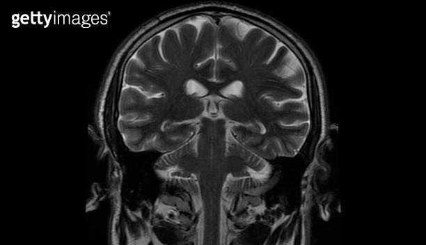 Brain Mri Scan Of Healthy Male Magnetic Resonance Imaging High Resolution 이미지 1172990790 
