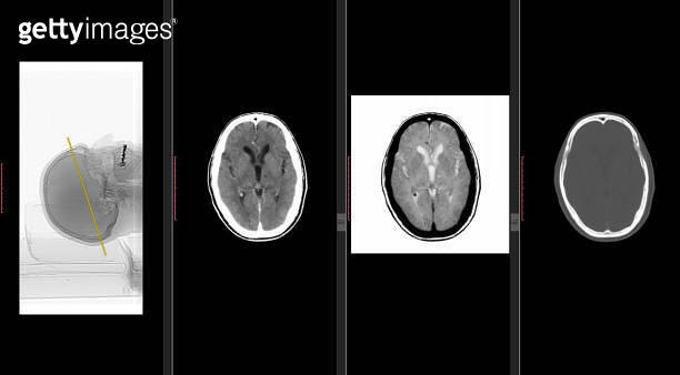 Brain CT Scan (Head Computed Tomography) High Resolution 이미지 ...