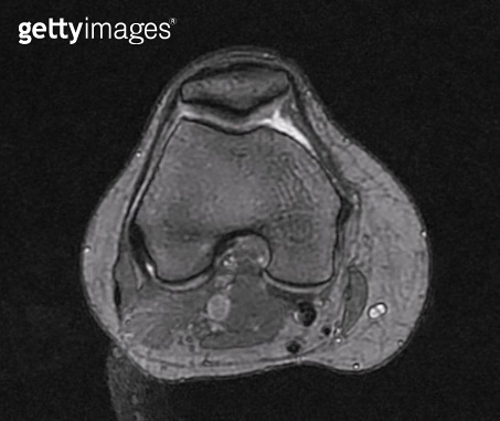 Knee MRI - Medical Imaging- Radiology- High Resolution Axial Knee ...