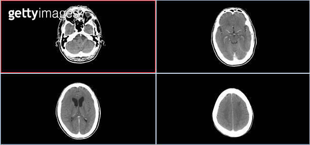 Brain CT Scan (Head Computed Tomography) High Resolution 이미지 ...