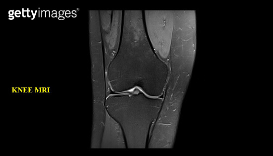 Knee MRI (Magnetic Resonance Imaging) 이미지 (1173420320) - 게티이미지뱅크