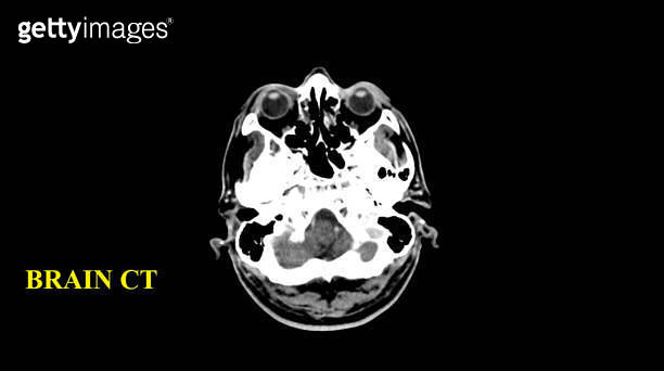 Brain CT Scan (Head Computed Tomography) High Resolution 이미지 ...