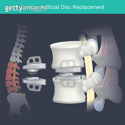 Lumbar Artificial Disc Replacement. 이미지 (1146202654) - 게티이미지뱅크
