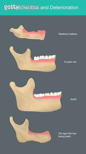 Jaw bone loss and Deterioration. When born, the body needs calcium to ...