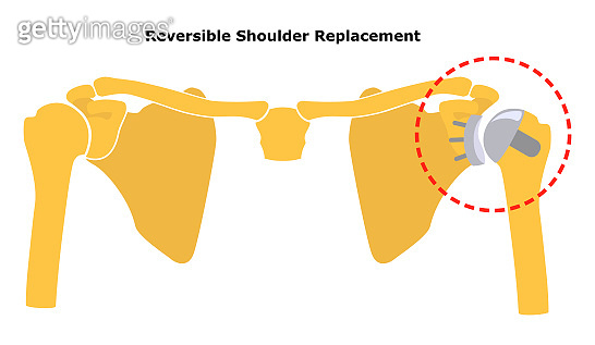 Reverse Shoulder Replacement. Shoulder joint replacement ...