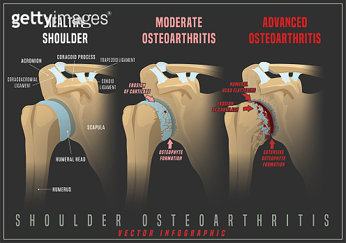 Shoulder osteoarthritis infographic (1164852295) 일러스트, 무료 일러스트 - 게티이미지뱅크