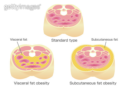 Type of obesity illustration. Abdominal sectional View. (visceral fat ...