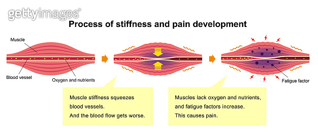 Process of muscle's stiffness and pain illustration ( with explanation ...