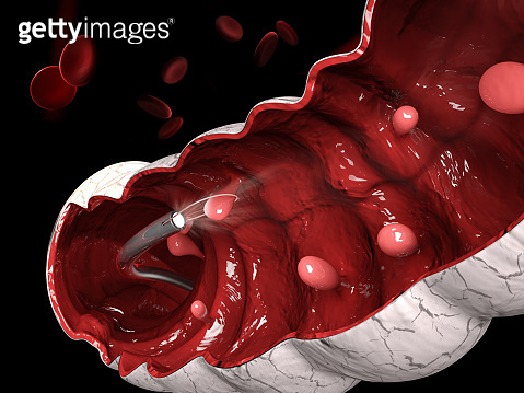 3d illustration of Removal of a colonic polyp with a electrical wire ...