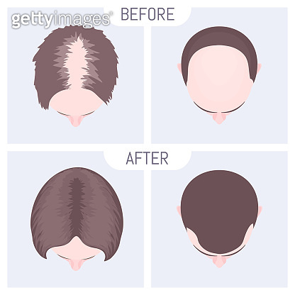 Female and male pattern alopecia set. Medical educational poster ...