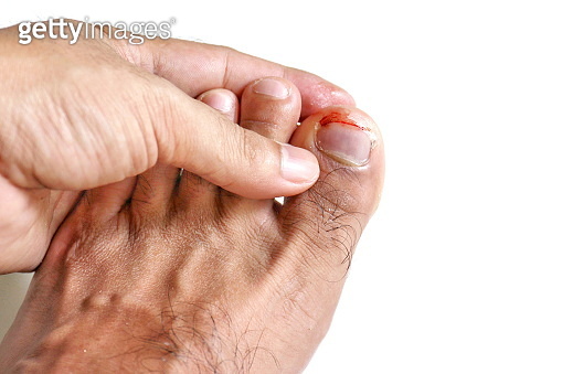 Figure out the nail, Accident nail trauma, bleeding toe nails, Foot ...