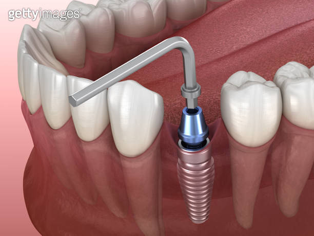 Implant abutment fixation procedure. Medically accurate 3D illustration ...