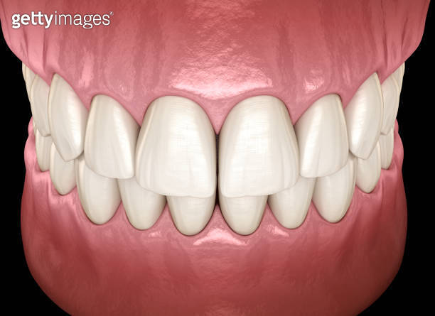 Healthy human teeth with normal occlusion, side view. Medically ...