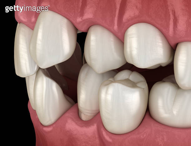 Abnormal teeth position, orthodontic concept. Medically accurate tooth ...