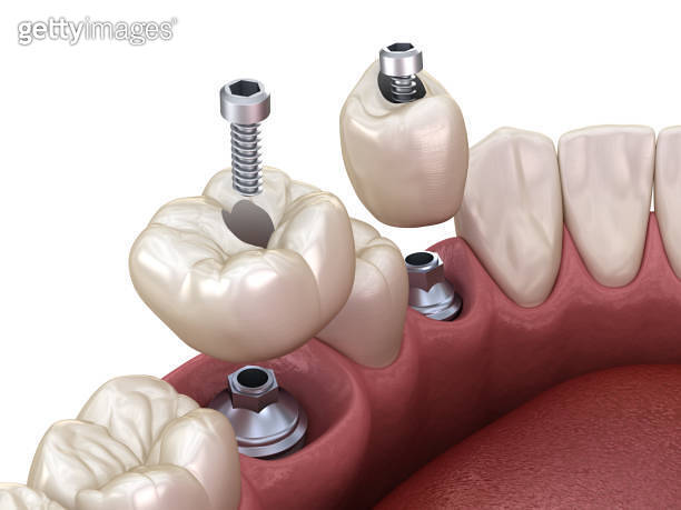 Premolar and Molar tooth crown installation over implant, screw ...