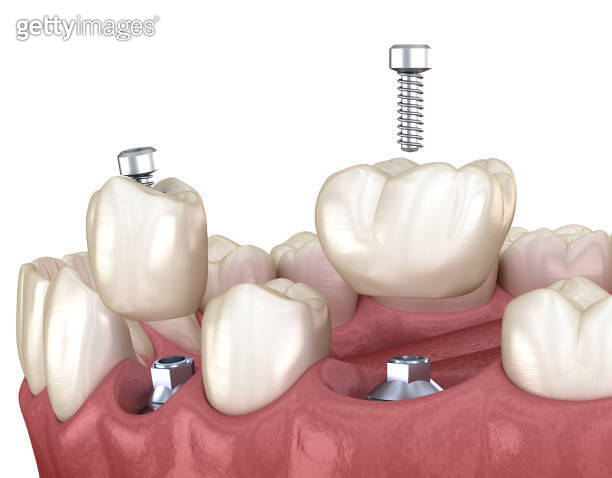 Premolar and Molar tooth crown installation over implant, screw ...