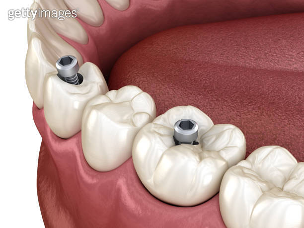 Premolar And Molar Tooth Crown Installation Over Implant Screw 6523