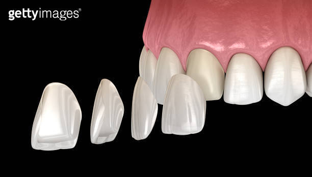 Veneer installation procedure over central incisor and lateral incisor ...