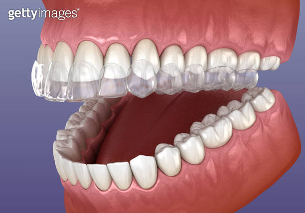 Invisalign braces or invisible retainer. Medically accurate dental 3D ...