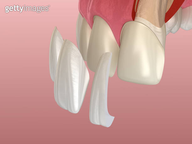 Veneer installation procedure over central incisor and lateral incisor ...