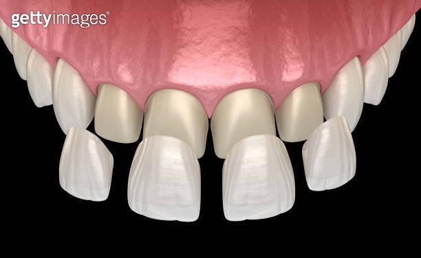 Veneer installation procedure over central incisor and lateral incisor ...