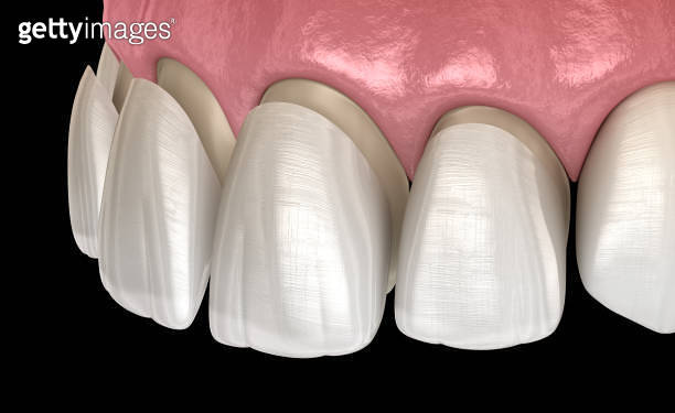 Veneer installation procedure over central incisor and lateral incisor ...