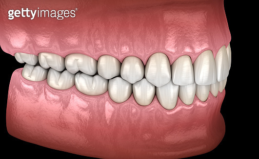 Healthy human teeth with normal occlusion, side view. Medically ...