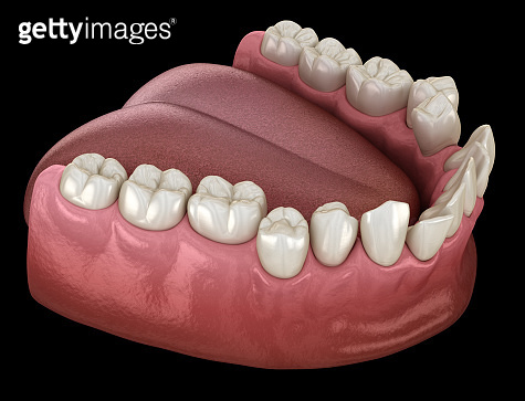 Abnormal teeth position, orthodontic concept. Medically accurate tooth ...