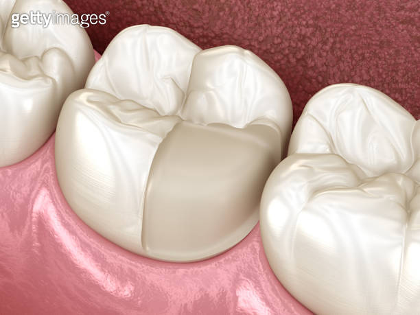 Preparation for Onlay ceramic crown fixation over tooth. Medically ...