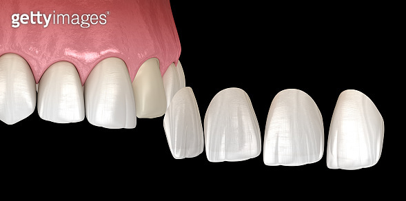 Veneer installation procedure over central incisor and lateral incisor ...