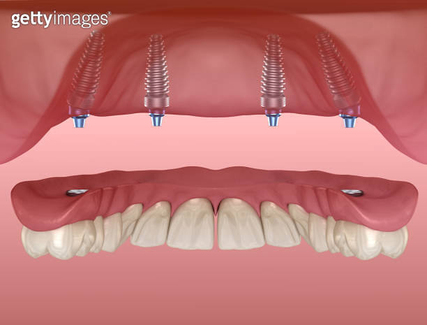 Maxillary prosthesis with gum All on 4 system supported by implants ...