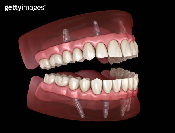 Maxillary and Mandibular prosthesis with gum All on 4 system supported ...