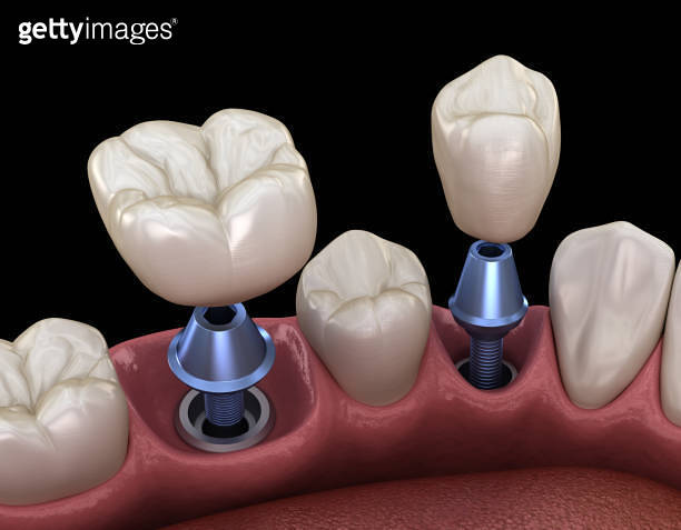 Premolar And Molar Tooth Crown Installation Over Implant Concept 3d 7204