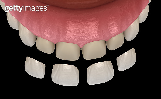 Veneer installation procedure over central incisor and lateral incisor ...
