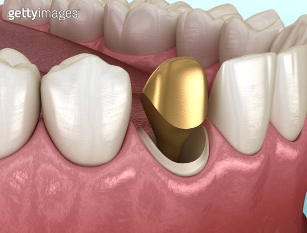 Golden stump pin tab on canaine tooth. Medically accurate dental 3D ...