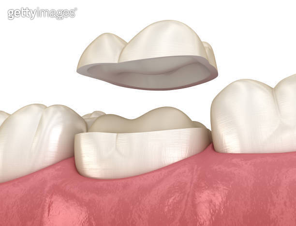 Onlay ceramic crown fixation over molar tooth. Medically accurate 3D ...
